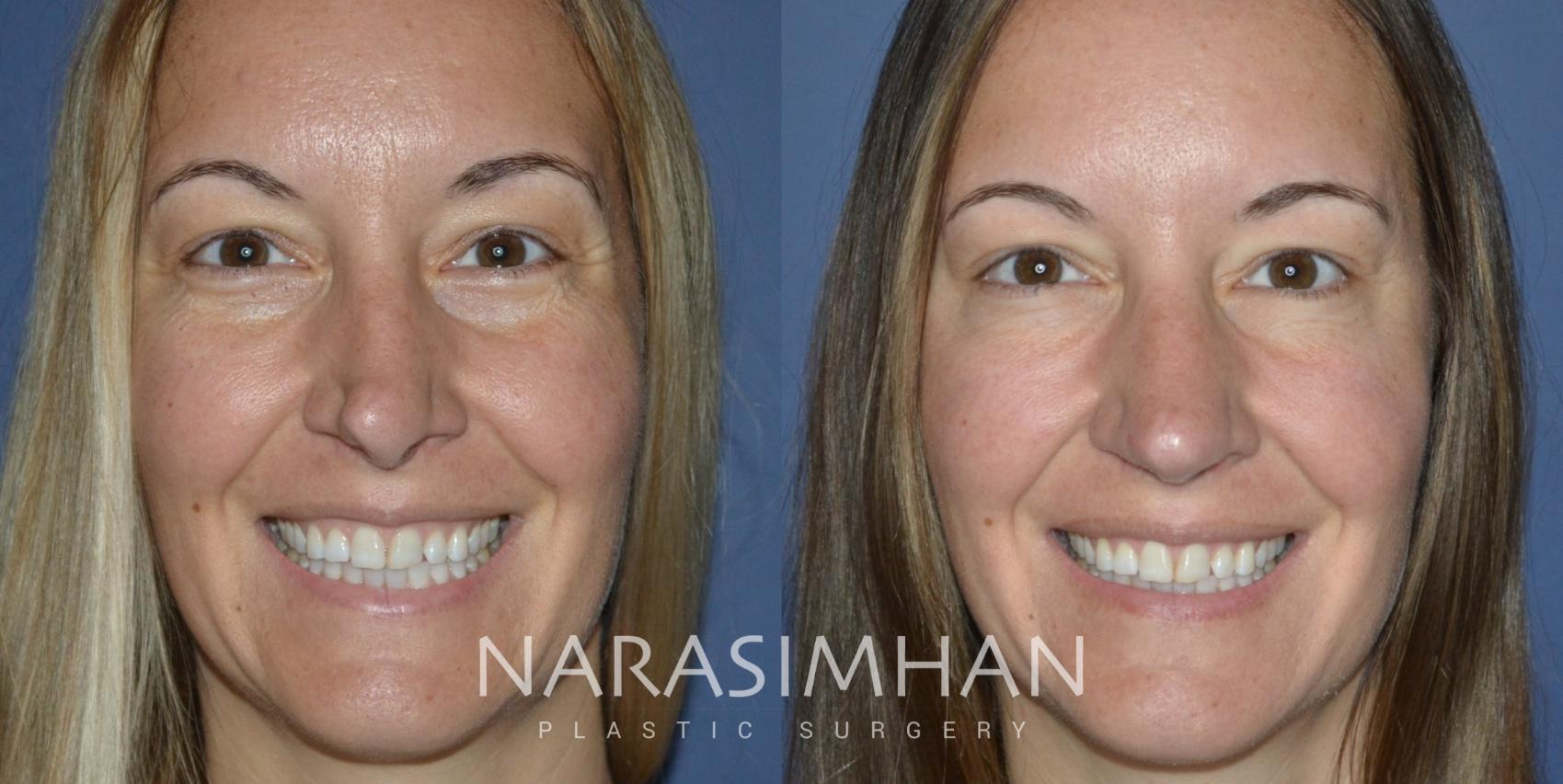 Revision Rhinoplasty Before and After Pictures Case 298 | Tampa ...