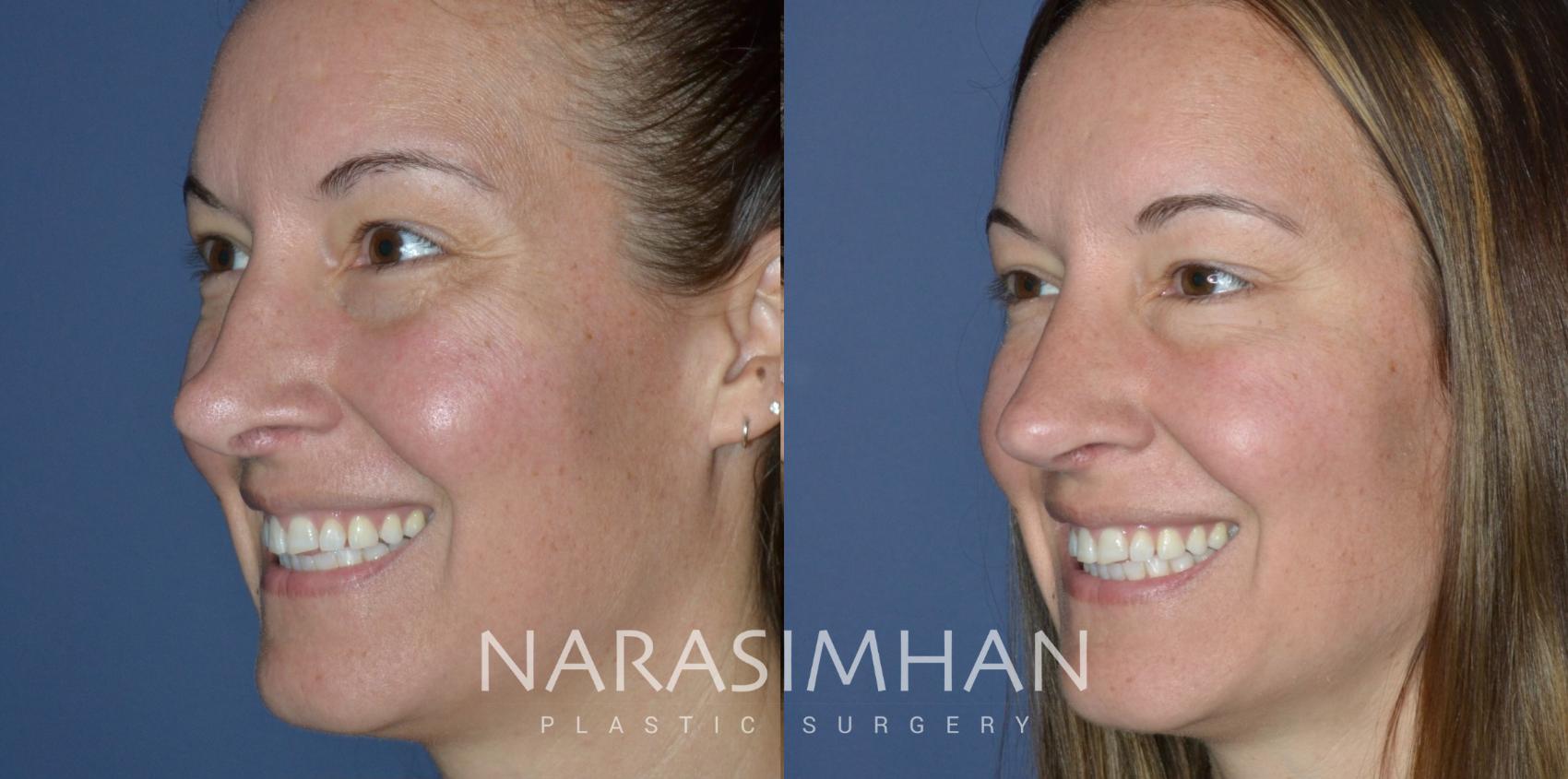 Revision Rhinoplasty Before and After Pictures Case 298 | Tampa ...