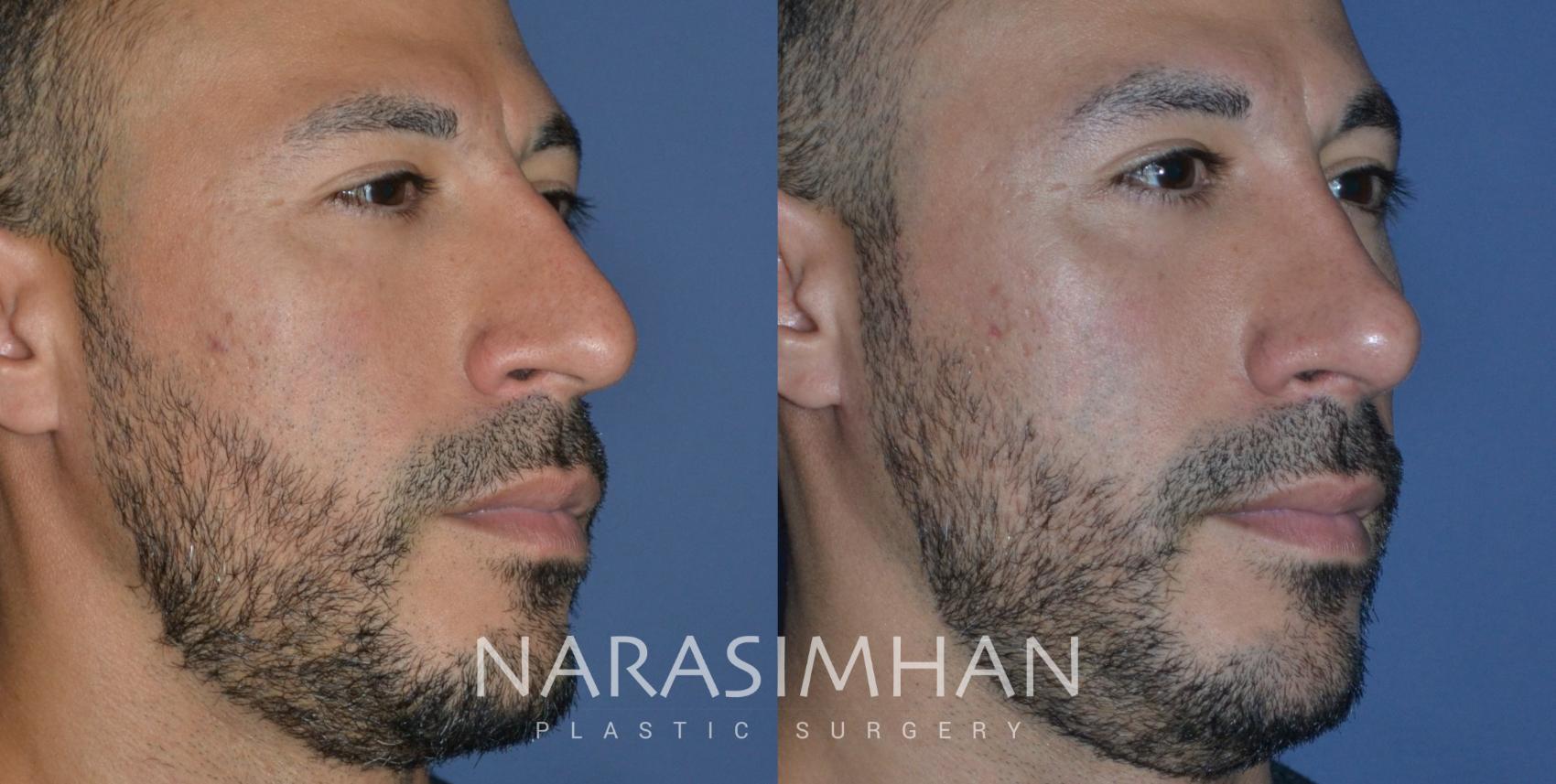 Rhinoplasty Before and After Pictures Case 294 | St Petersburg, Florida ...